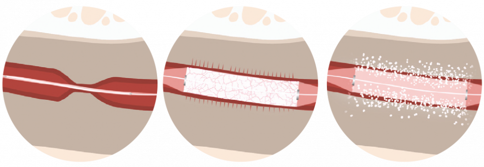 Optilume - Urologie-Erlangen